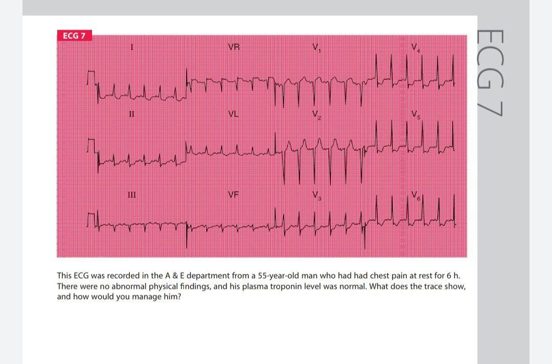 Solved ECG 7 VR М. N Publishers ECG 7 II VL Presenterenhanh | Chegg.com