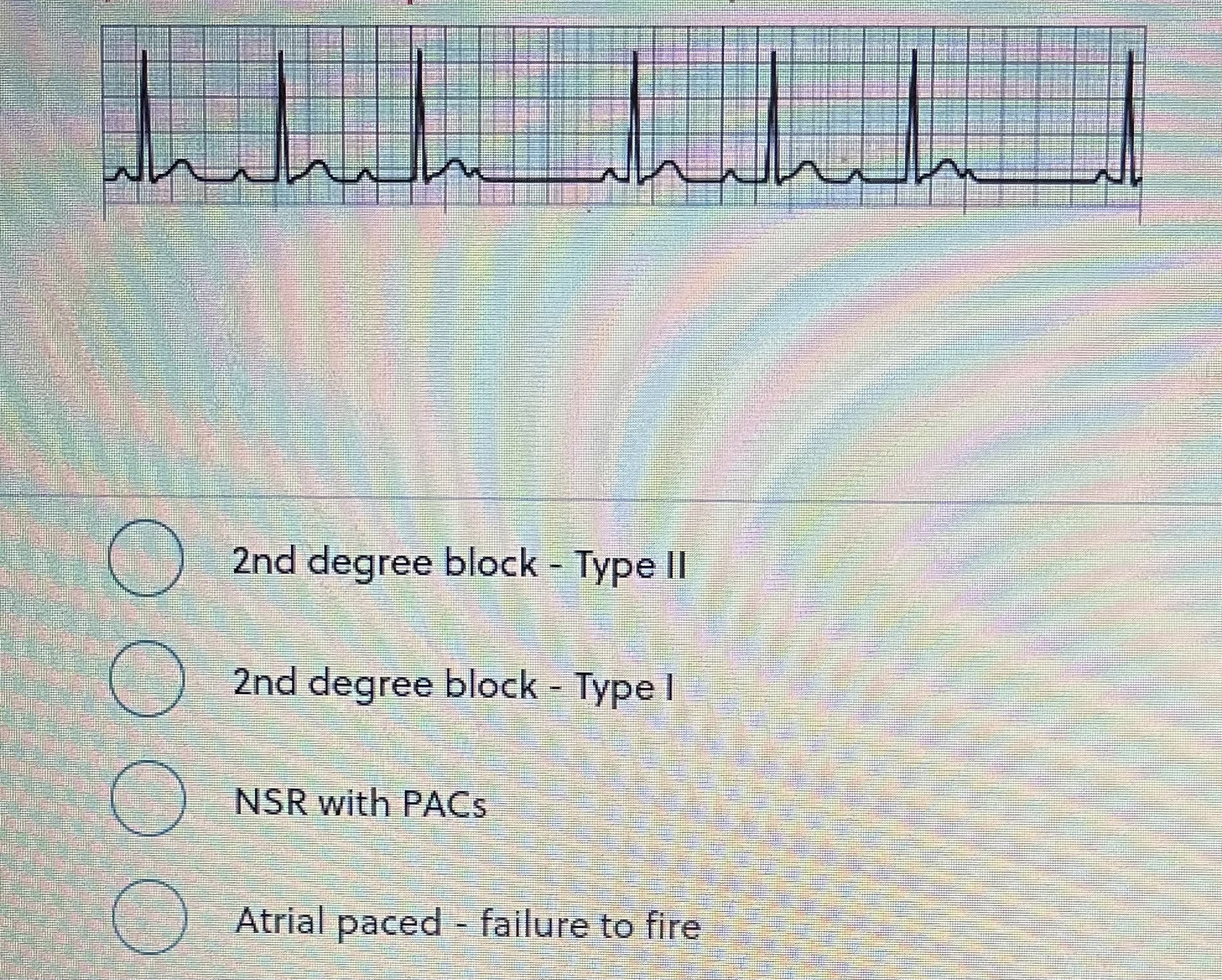 Solved 2nd degree block - Type II 2nd degree block - Type I | Chegg.com