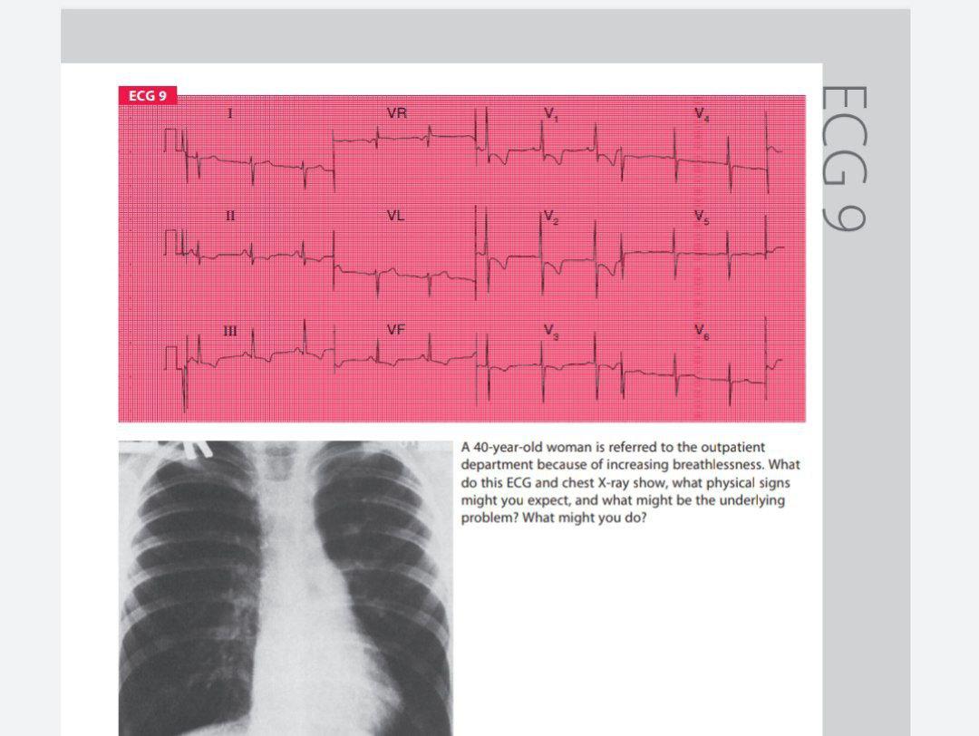 ECG 9 1 VR V V ECG 9 VL п VF V ااااااااات A | Chegg.com