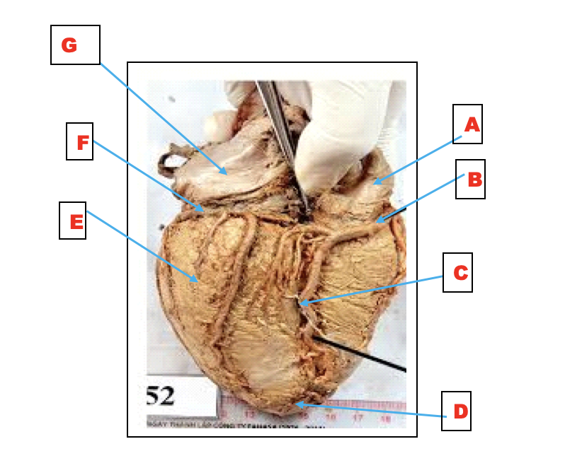 Diaphragmatic Surface Of Heart