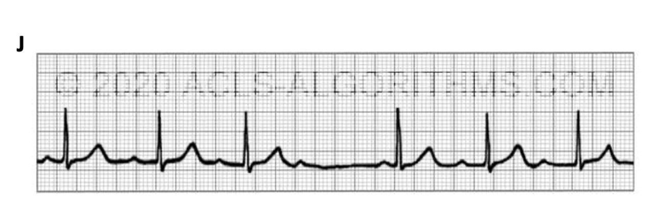 For each of the Lead II ECG traces of a resting heart | Chegg.com