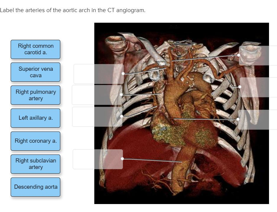 Solved Label the arteries of the aortic arch in the CT | Chegg.com