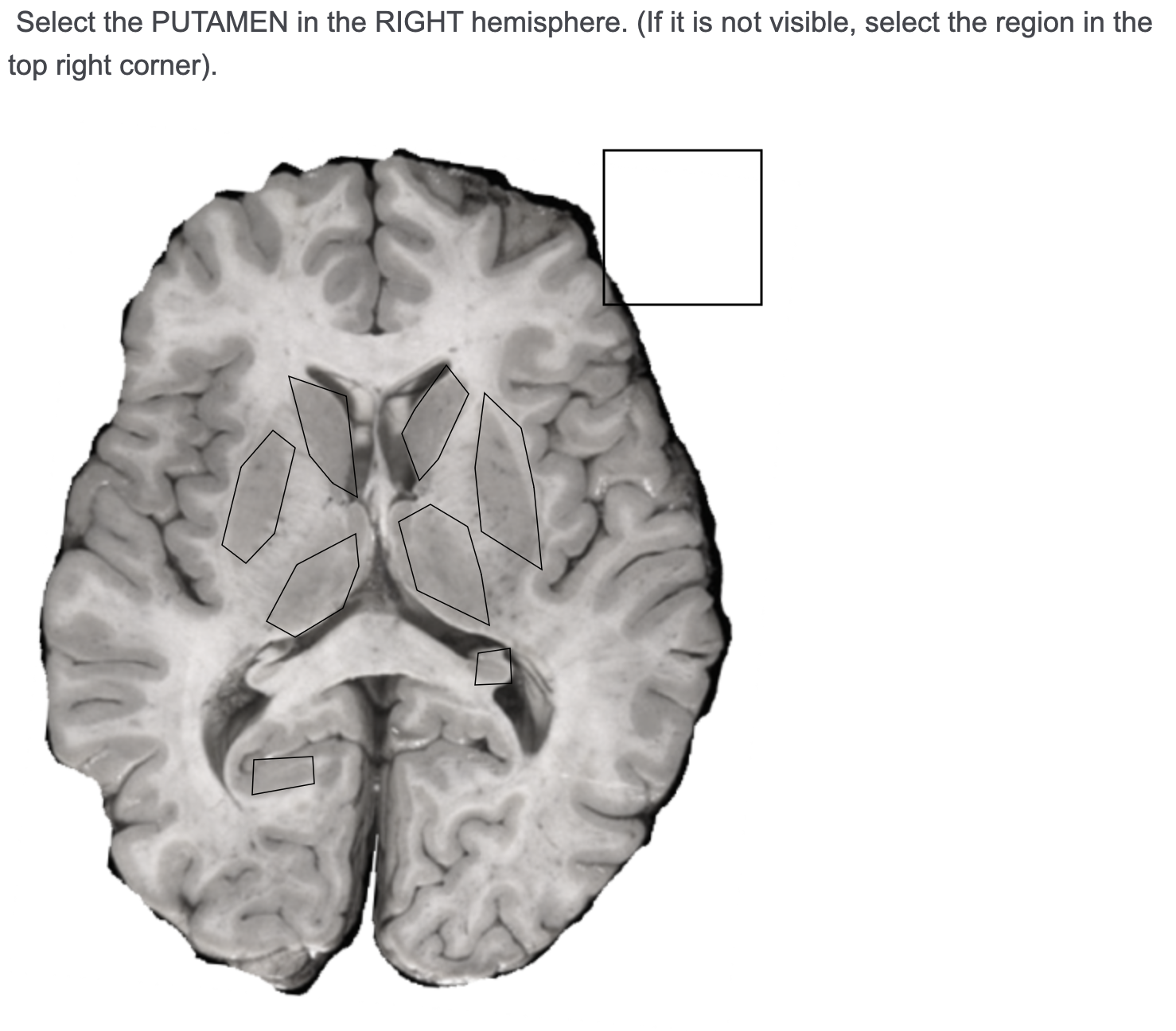 Solved Select the PUTAMEN in the RIGHT hemisphere. (If it is | Chegg.com