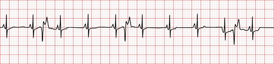 Solved Normal Sinus Rhythm with Multifocal PVC'sSinus | Chegg.com