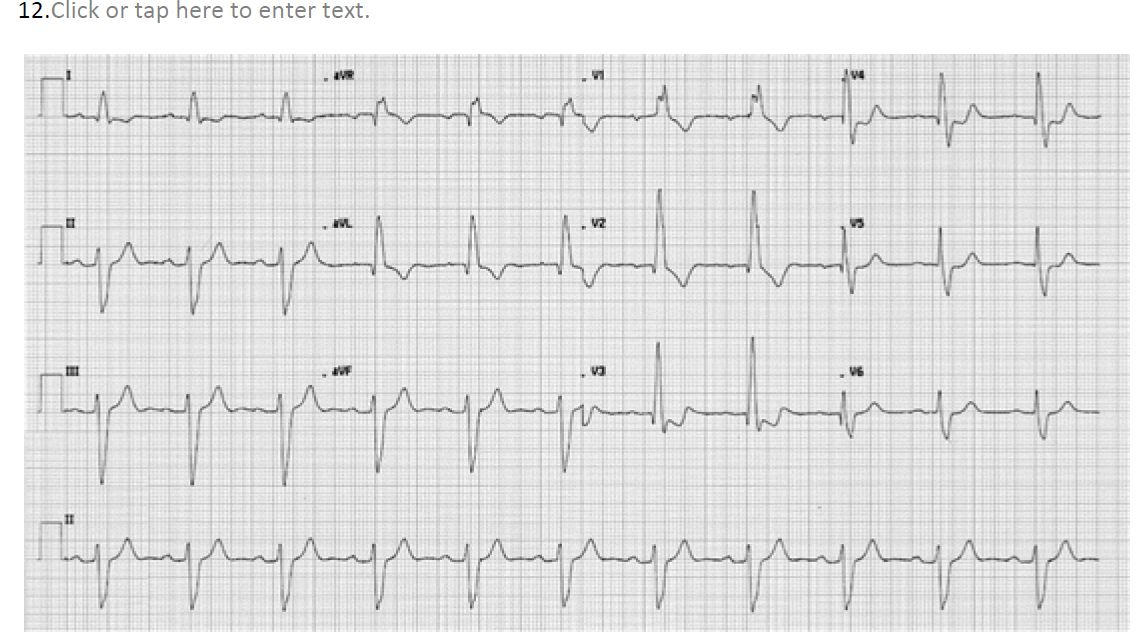 Solved Determine the type of Block shown in the ECG...There | Chegg.com