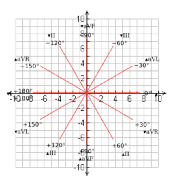 Solved Question : Determine the axis of this ECG. Is it | Chegg.com