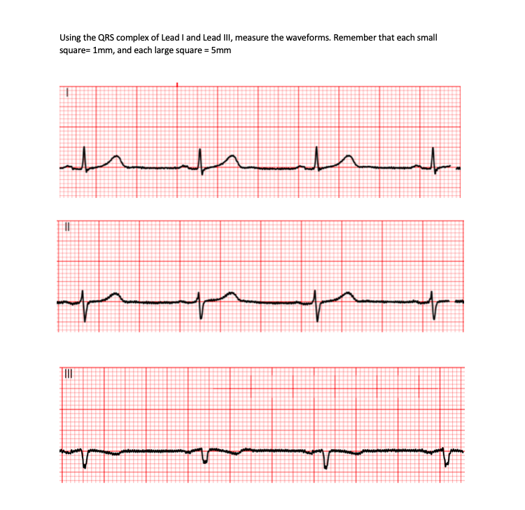 Solved 1 What Is A Mean Electrical Axis 2 Describe How