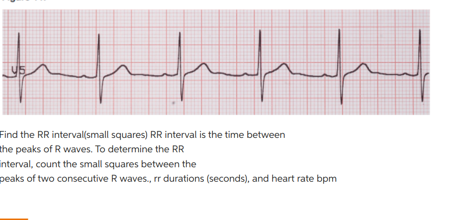 Solved Find the RR interval(small squares) RR interval is | Chegg.com