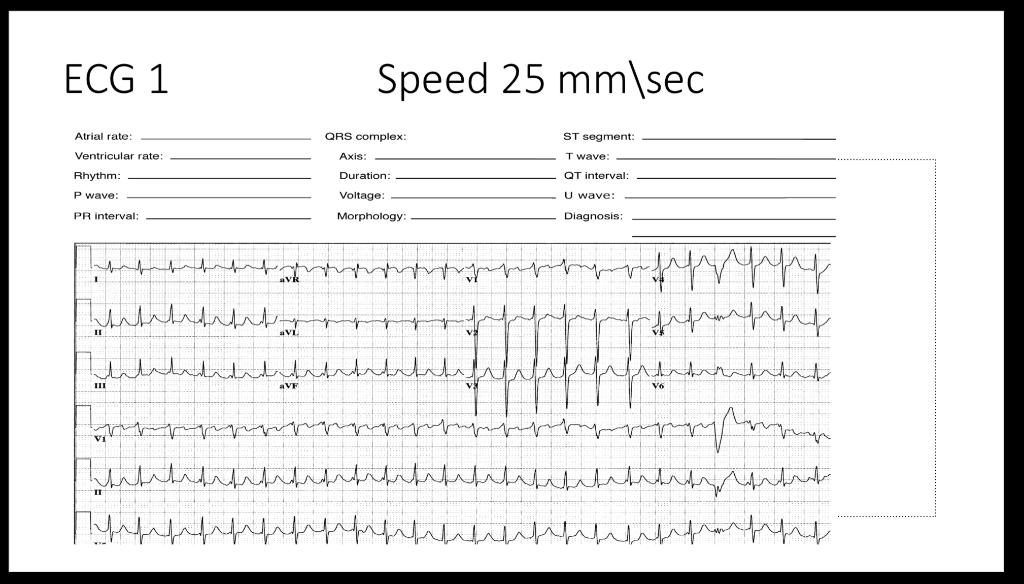 ECG 1 Speed 25 mm\sec QRS complex: Atrial rate: | Chegg.com