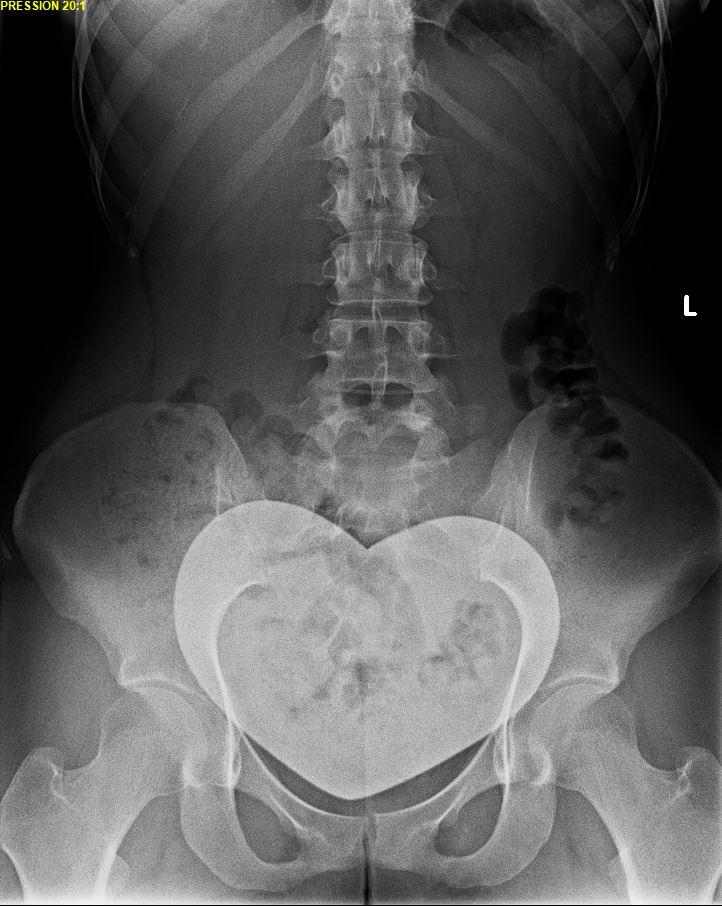 Solved 1. Locate the left L2 transverse process. Locate | Chegg.com