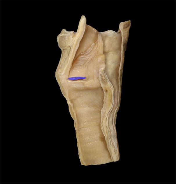 Ventricular Folds Cadaver
