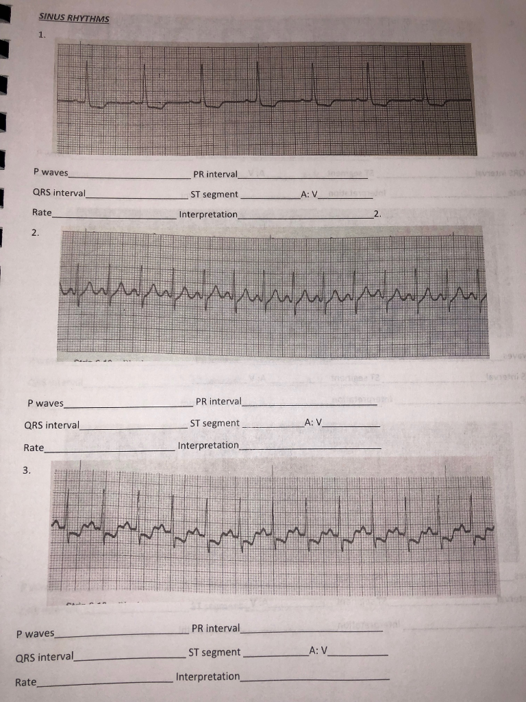 SINUS RHYTHMS P waves QRS interval Rate PR interval | Chegg.com