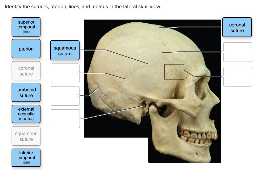 Solved Identify the sutures, pterion, lines, and meatus in | Chegg.com