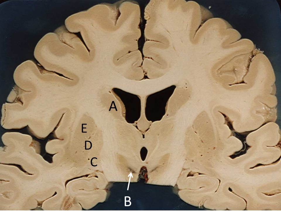 Solved Which letters identify the basal ga nglia nuclei | Chegg.com