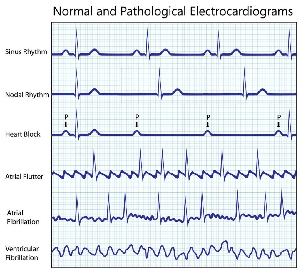 Solved Normal and Pathological Electrocardiograms ملی Sinus | Chegg.com