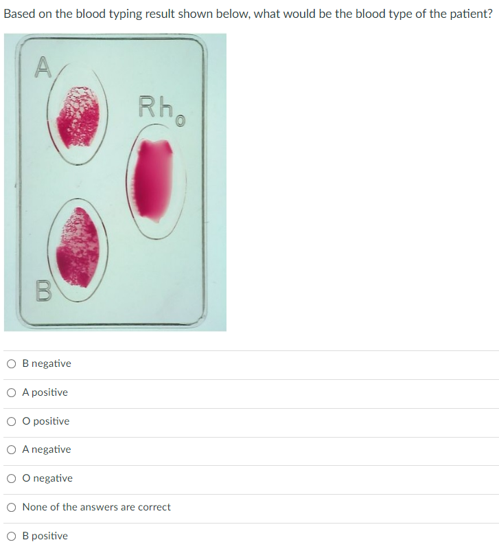 Solved Based on the blood typing result shown below, what | Chegg.com