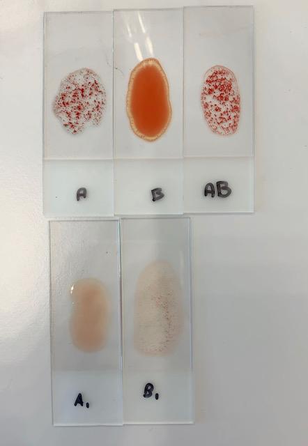 Solved On the top we added antibody A with diluted blood, | Chegg.com