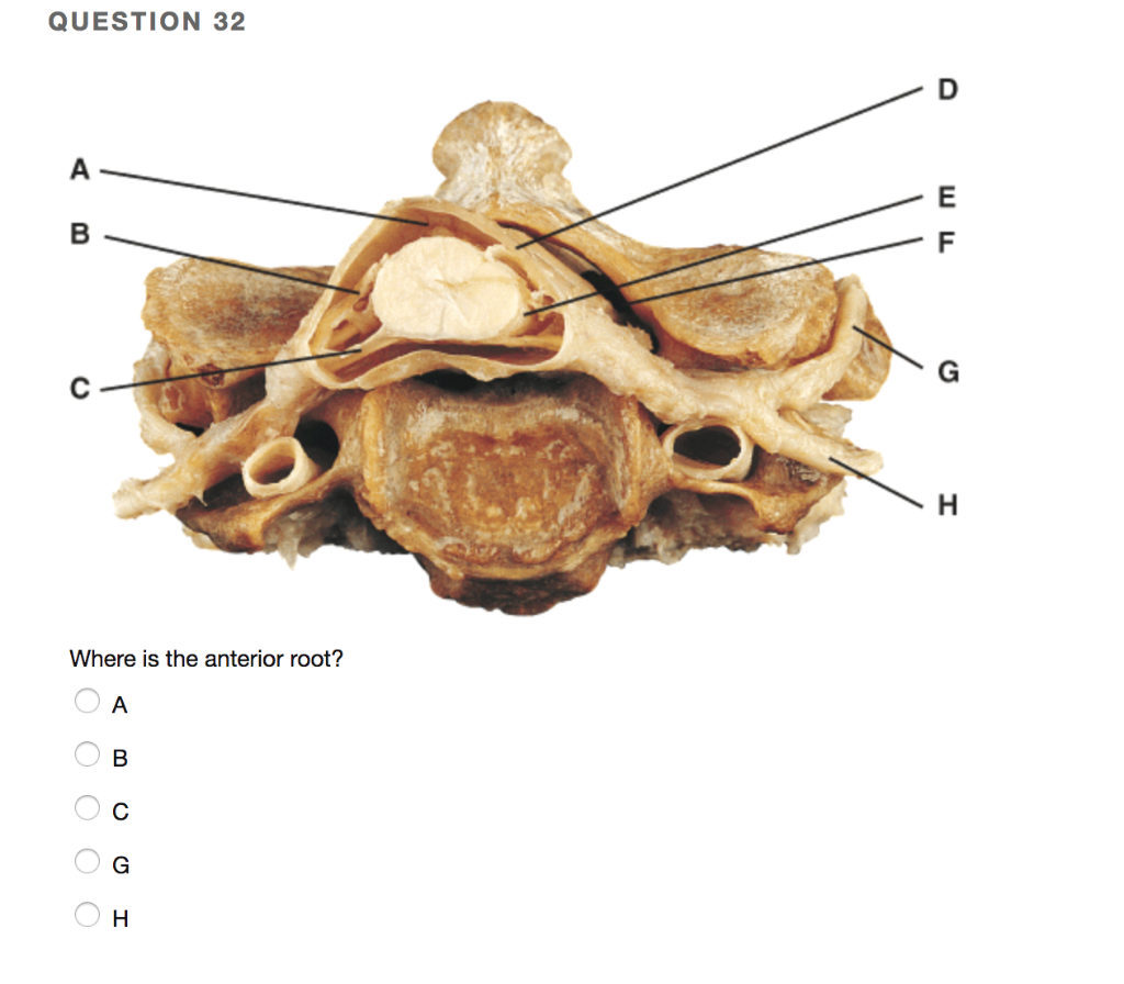 Solved QUESTION 30 Where is the posterior ramus? None of the | Chegg.com