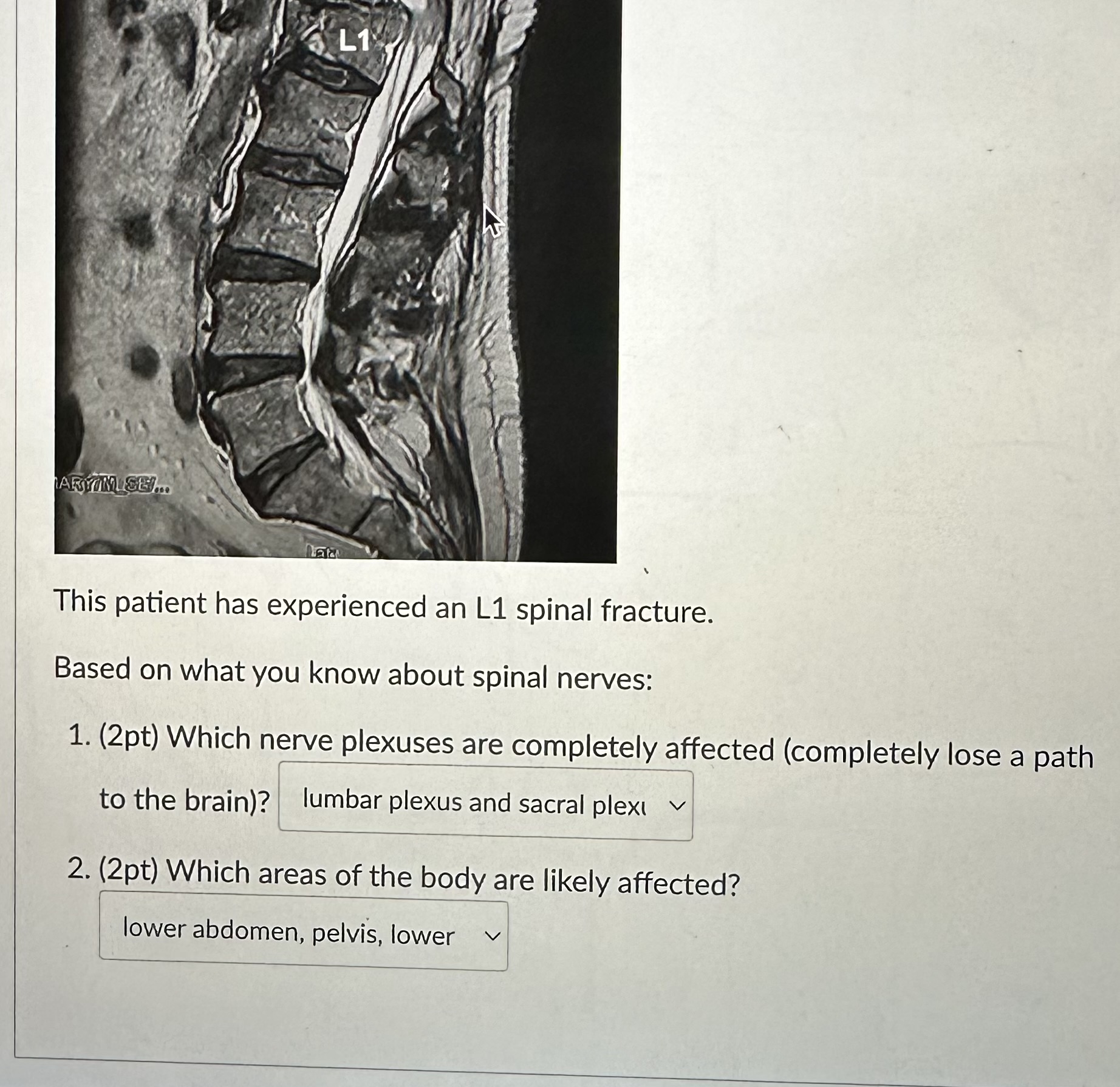 Solved This patient has experienced an L1 spinal fracture. | Chegg.com
