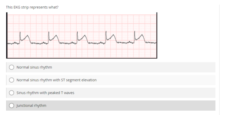 Solved This EKG strip represents what? Normal sinus rhythm | Chegg.com