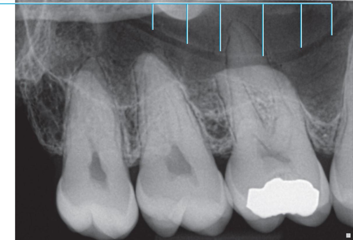 Nutrient Canal Radiograph