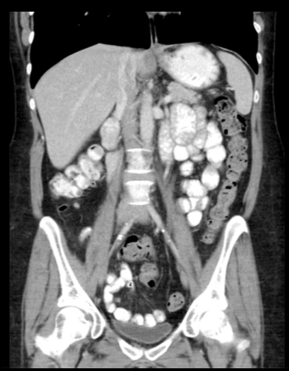 Normal Ct Scan Abdomen