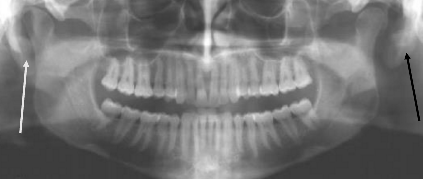 Hamulus Radiograph