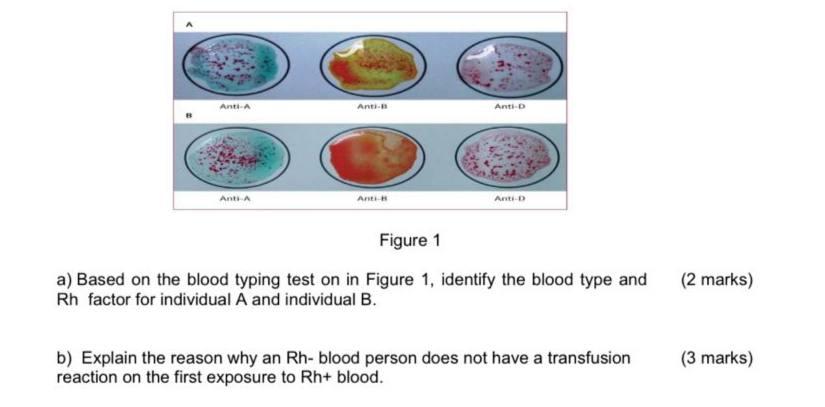 Solved Figure 1 a) Based on the blood typing test on in | Chegg.com