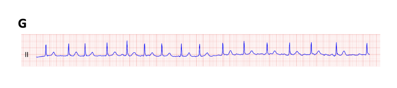 For each of the Lead II ECG traces of a resting heart | Chegg.com