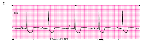 Solved Label the arrhythmia type on the EKG strip: (No | Chegg.com