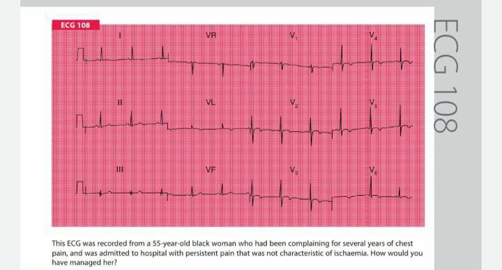 Solved ECG 108 VR V ECG 108 11 VL. VE V le+ This ECG was | Chegg.com