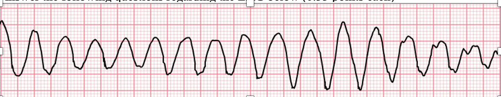 Solved Are the R to R’ intervals regular or irregular, Is | Chegg.com