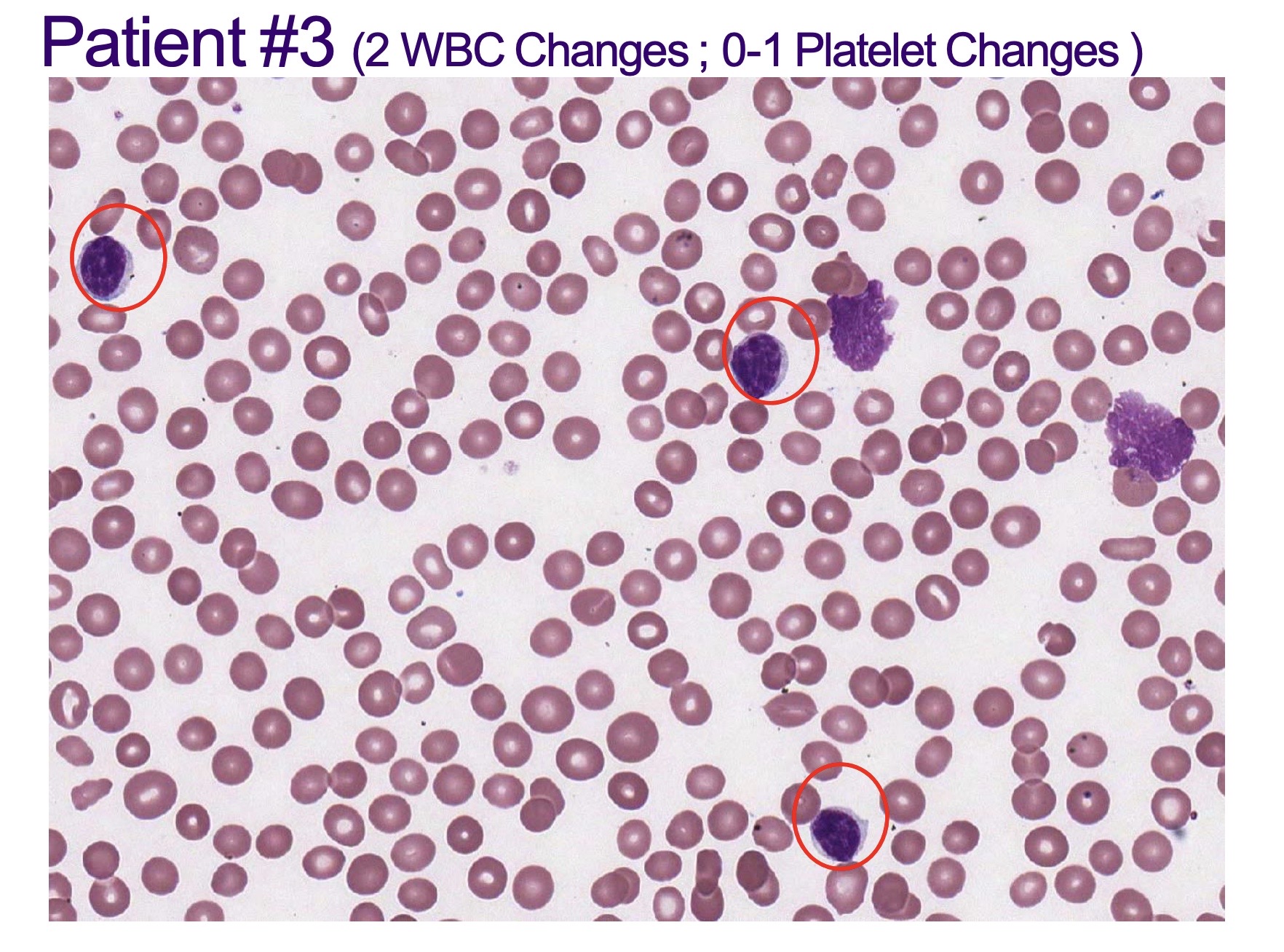 Solved Patient \#1 (1-2 WBC changes; 1-2 Plt changes) Age: | Chegg.com