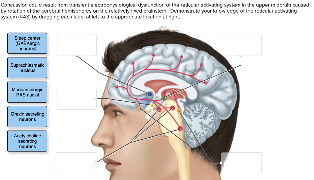 Solved Concussion could result from transient | Chegg.com