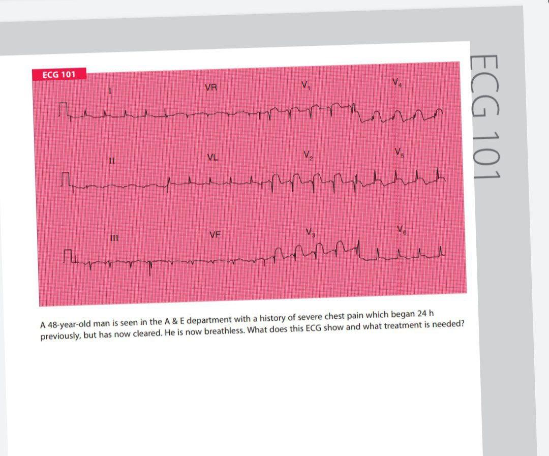 Solved ECG 101 Vi V. VR I ECG 101 V V 11 poriana wenigniew | Chegg.com