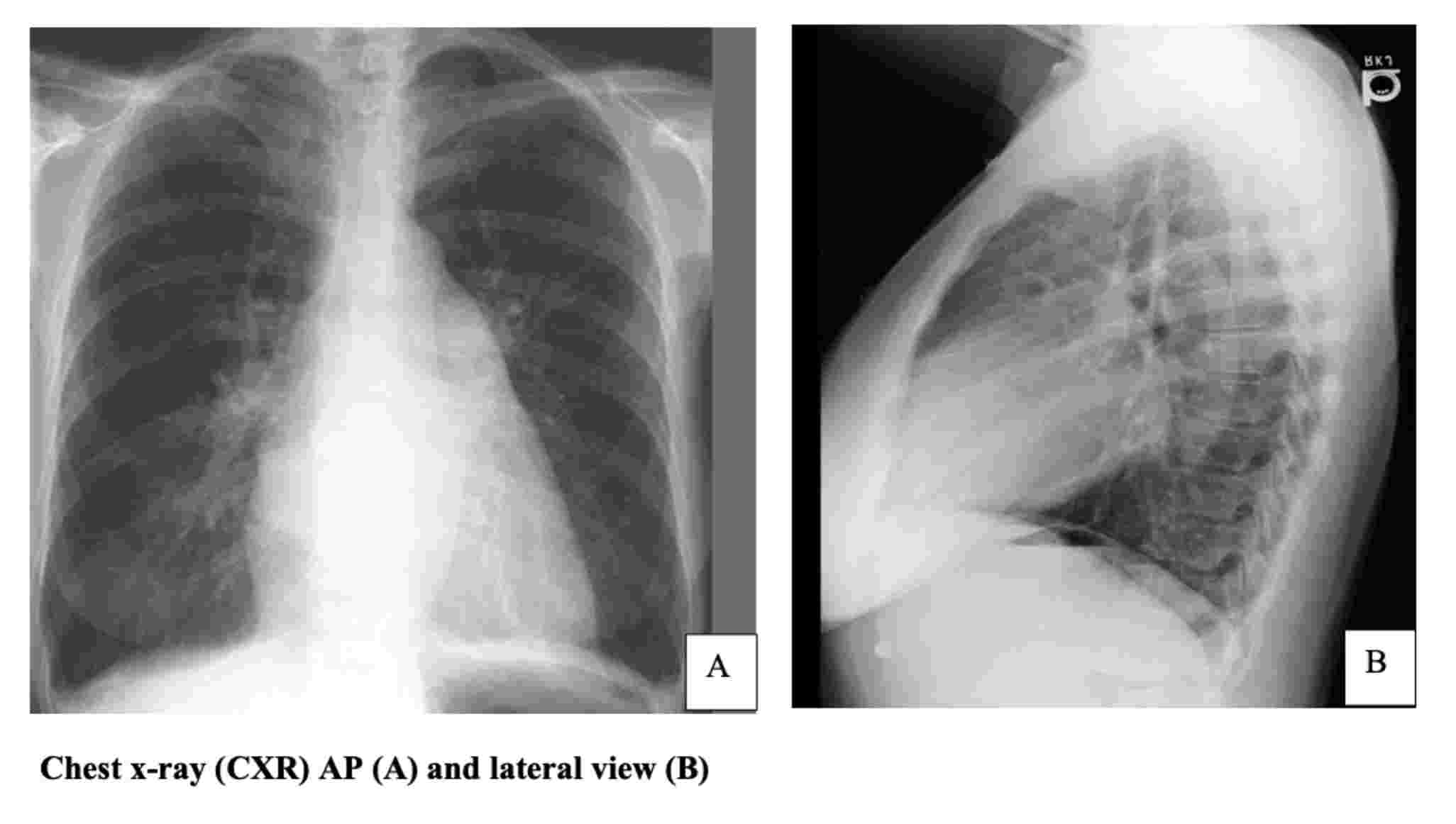 Solved Chest x-ray (CXR) ﻿AP (A) ﻿and lateral view (B) ﻿What | Chegg.com