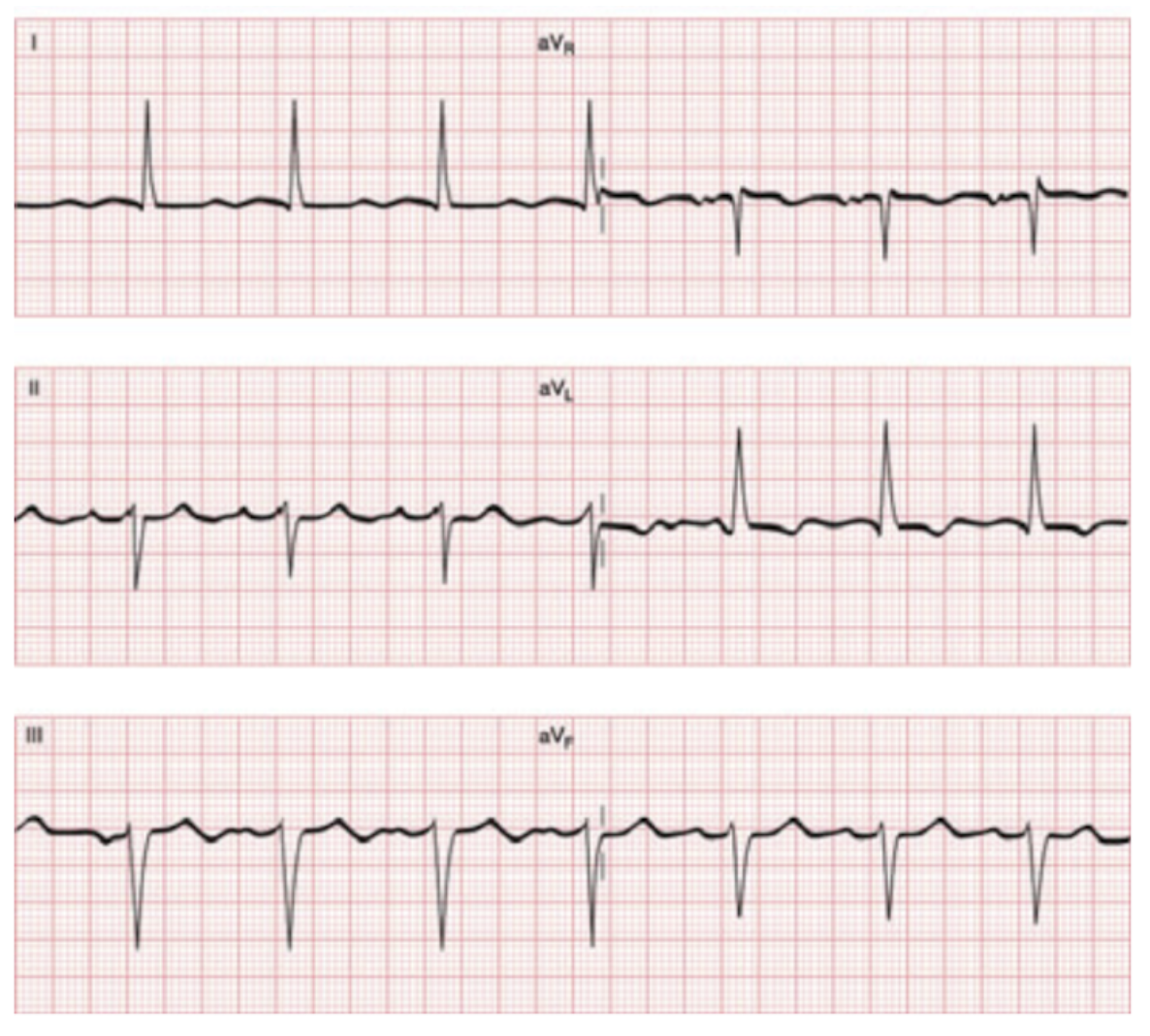 Solved Question : Determine the axis of this ECG. Is it | Chegg.com