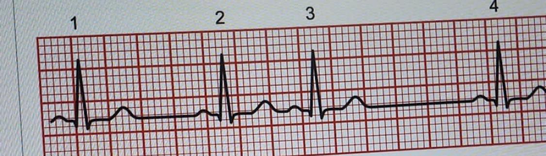 Solved 1. There are ___# small boxes for the QRS complex of | Chegg.com
