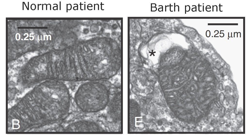 Solved Barth syndrome is a mitochondrial disorder caused by | Chegg.com