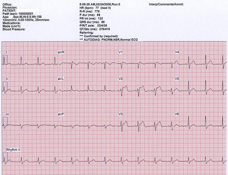 Exercise ECG Resting ECG Using the bottom | Chegg.com