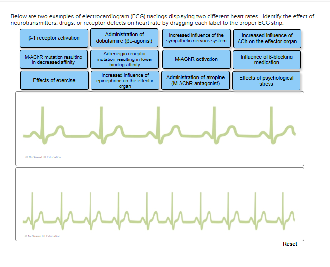 Below are two examples of electrocardiogram (ECG) | Chegg.com
