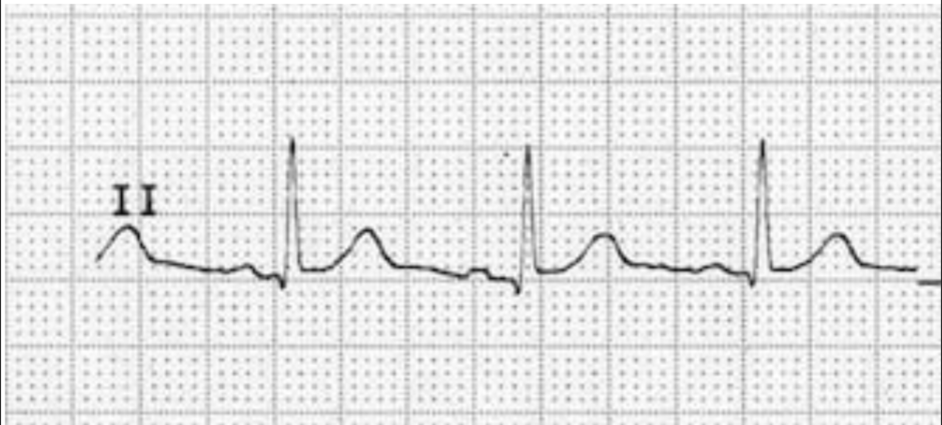Solved Instructions: You have recorded the attached ECG on | Chegg.com