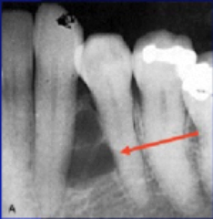 Botryoid Odontogenic Cyst