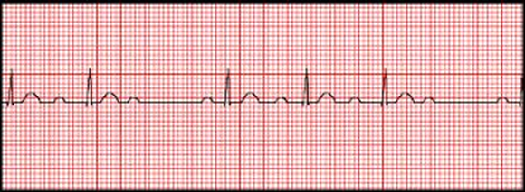 [Solved]: which identifies what is occurring on this EKG. Si