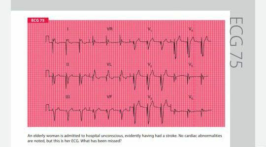 Solved ECG 25 VA ECG 75 མཁས་པ་ཡོད་ན ད" | དད་པའི་རིགས་ལ། | Chegg.com