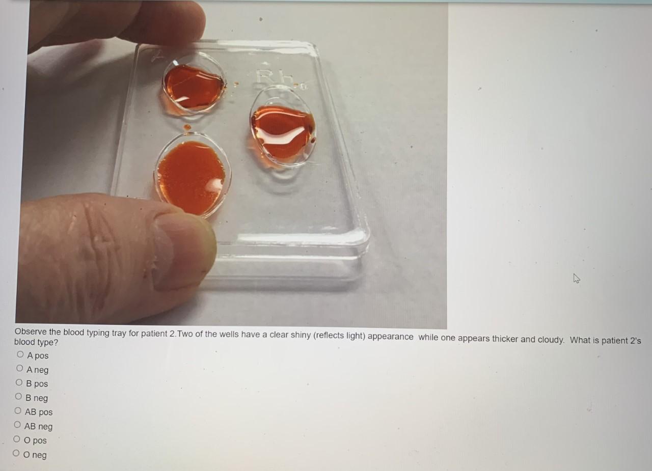 Solved Observe the blood typing tray for patient 2. Two of | Chegg.com