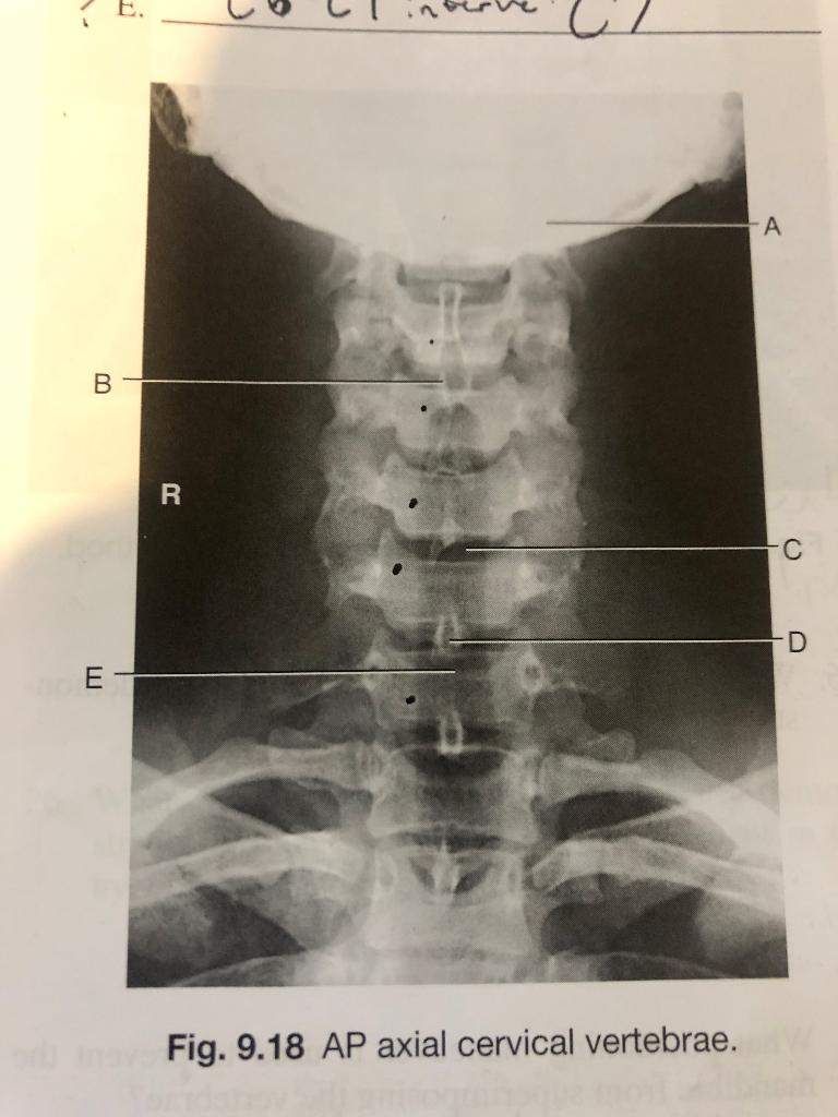 Solved D Fig. 9.18 AP axial cervical vertebrae. | Chegg.com