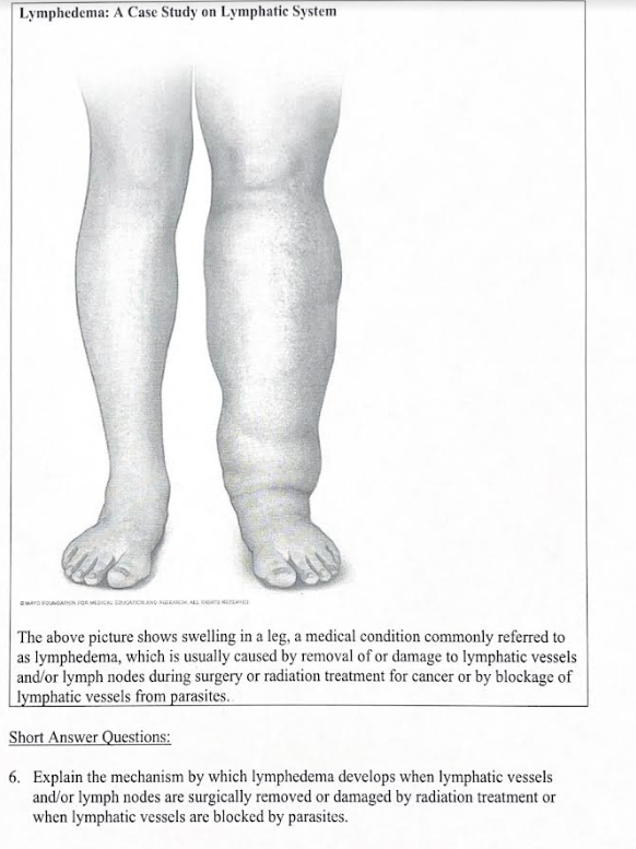 Solved Lymphedema: A Case Study on Lymphatic System The | Chegg.com
