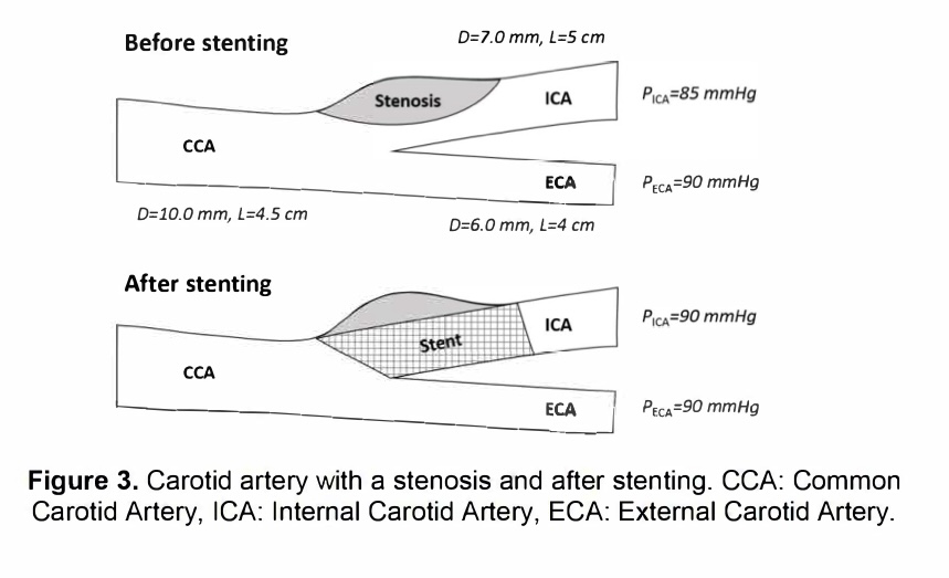 Solved A patient was found to have a stenosis in one of the | Chegg.com