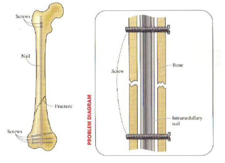Solved This type of intramedullary nail is connected to the | Chegg.com